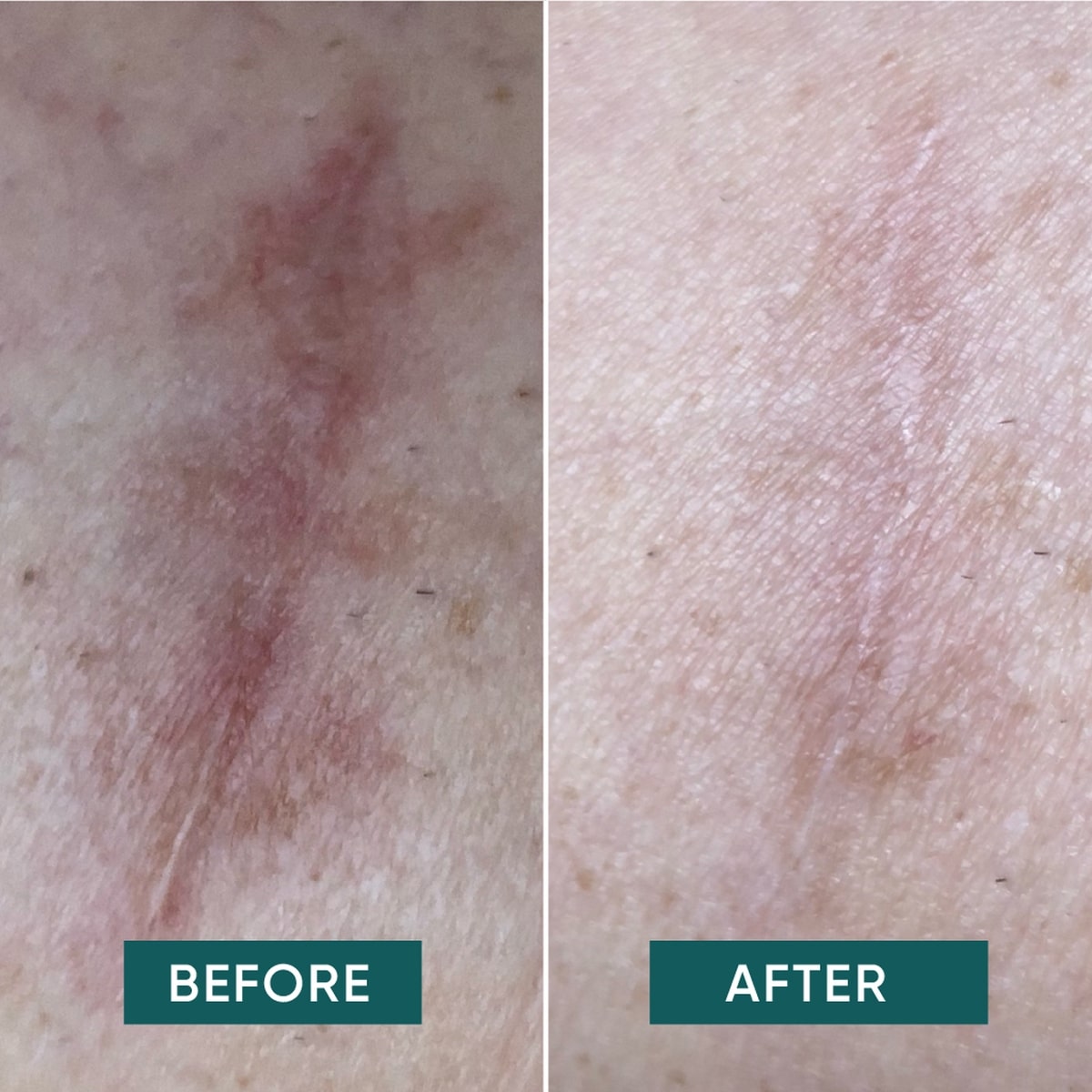 Apricot Beauty • Reusable Scar Pads with Aloe Vera - Mini